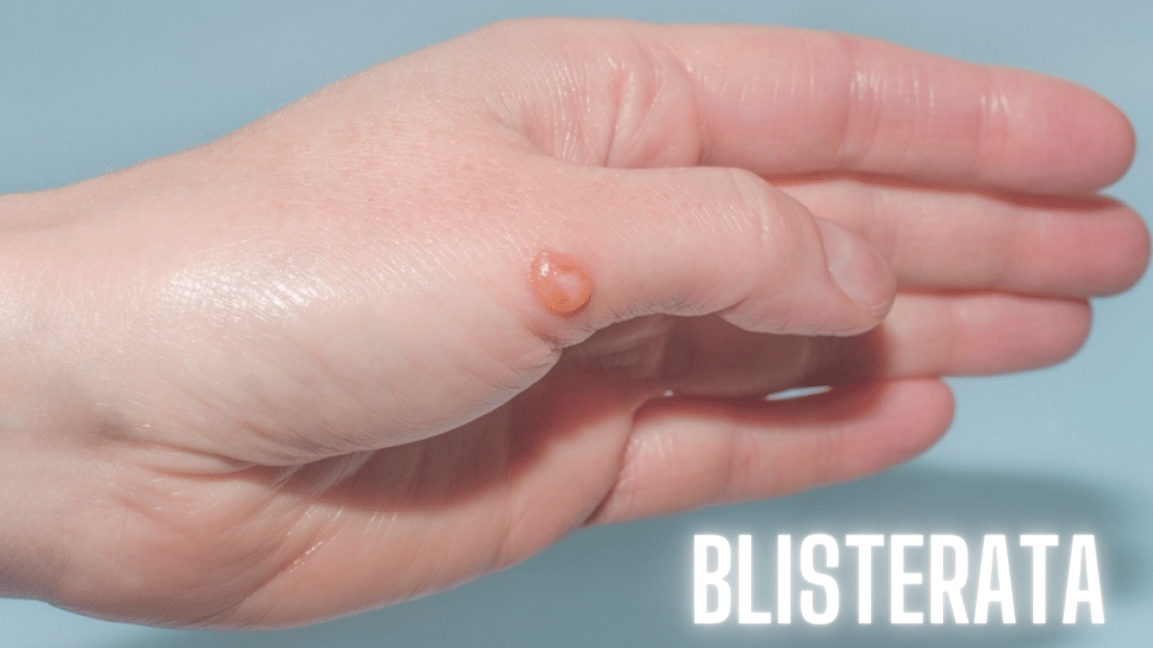 Understanding Blisterata: Causes, Symptoms, and Treatment - Trend Bizz